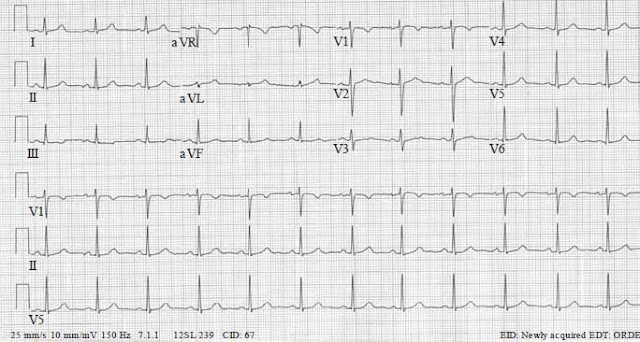 Chronic Stable Coronary Artery Disease Case File