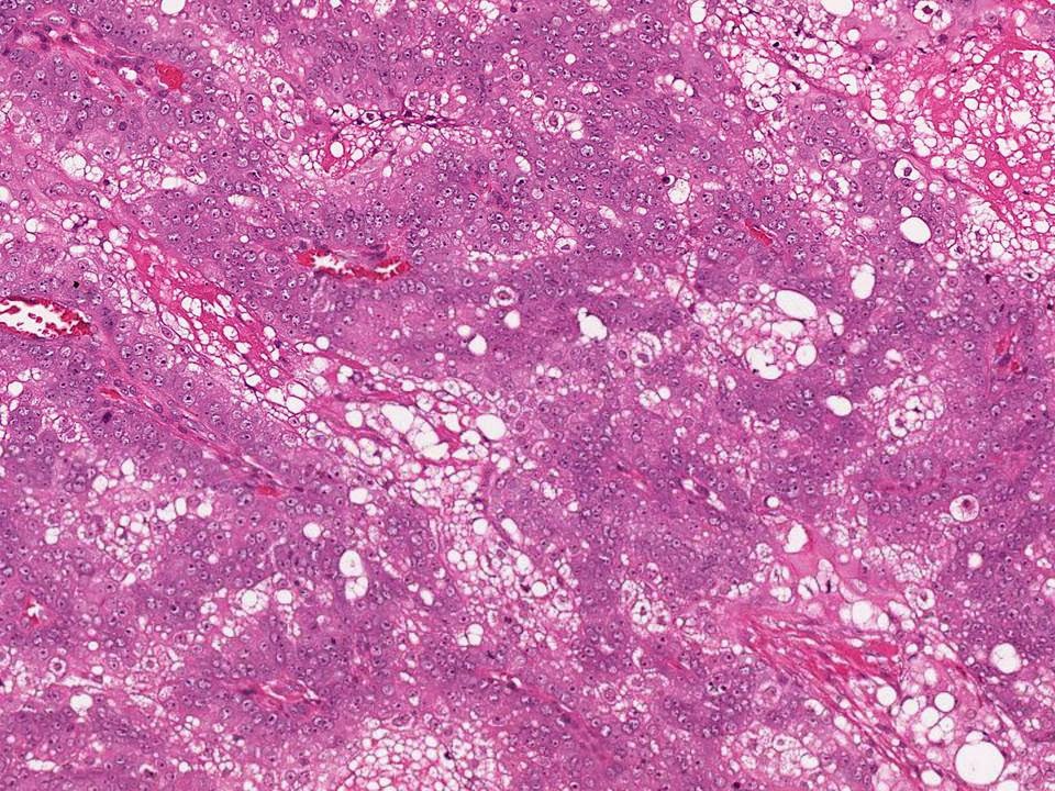Dermpath Made Simple - Neoplastic: Sebaceous Tumours