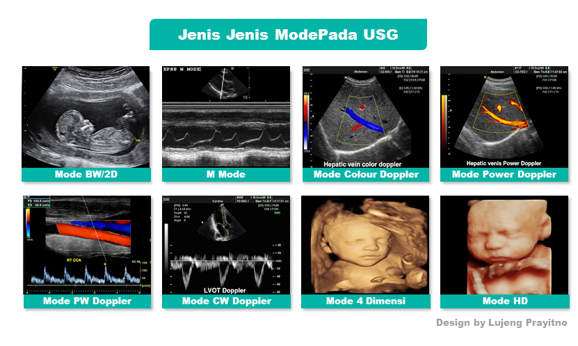 Sejarah Ultrasonografi (USG)