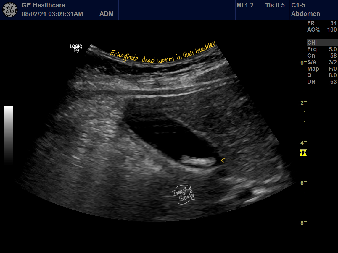 Case 31: Worm in Gallbladder - Biliary Ascariasis ~ Imaging Study