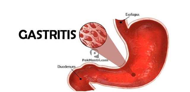 Gastritis Pengertian, Penyebab dan Tanda Gejala