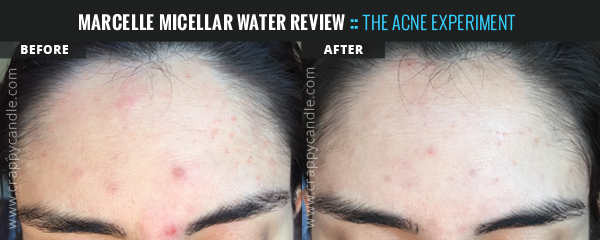 Marcelle Micellar Water Review - The Acne Experiment | Crappy Candle