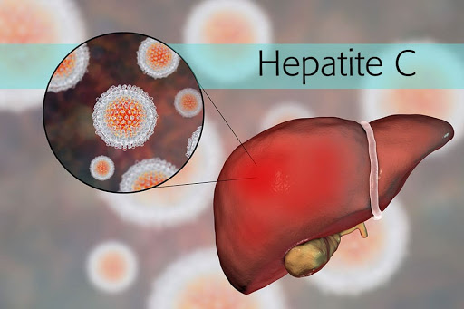 Hepatite C, doença e sintomas.