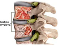 bahaya penyakit leukimia: Mengobati Tradisional Mieloma Multipel