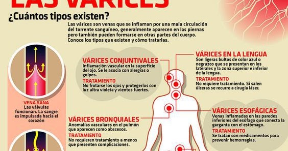 Como curar las varices: Diferentes tipos de venas varicosas