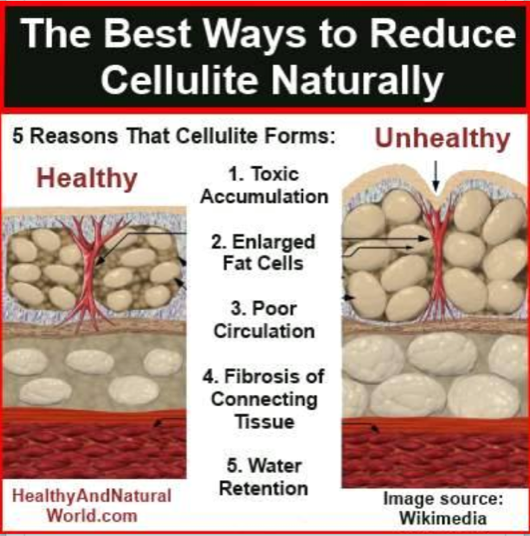 Love.Wonder.Link: How To Get Rid Of Cellulite