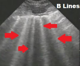 B-Lines Lung Ultrasound - Sumer's Radiology Blog