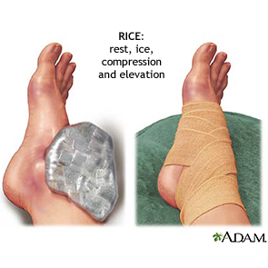Me he torcido el pie: ¿qué hago? - Farmacia Torrens