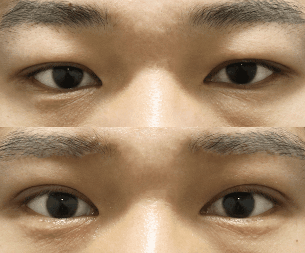 [JW Bedah Plastik Korea] Sub Brow lifting atau forehead lifting