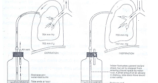 TINDAKAN PEMASANGAN & PERAWATAN WSD (WATER SEAL DRAINAGE)