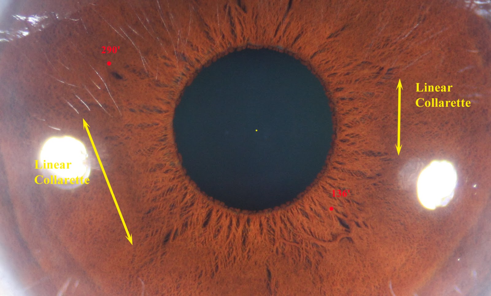 Modern & Multidimensional Iridology: Diabetes Mellitus Signs in Modern ...