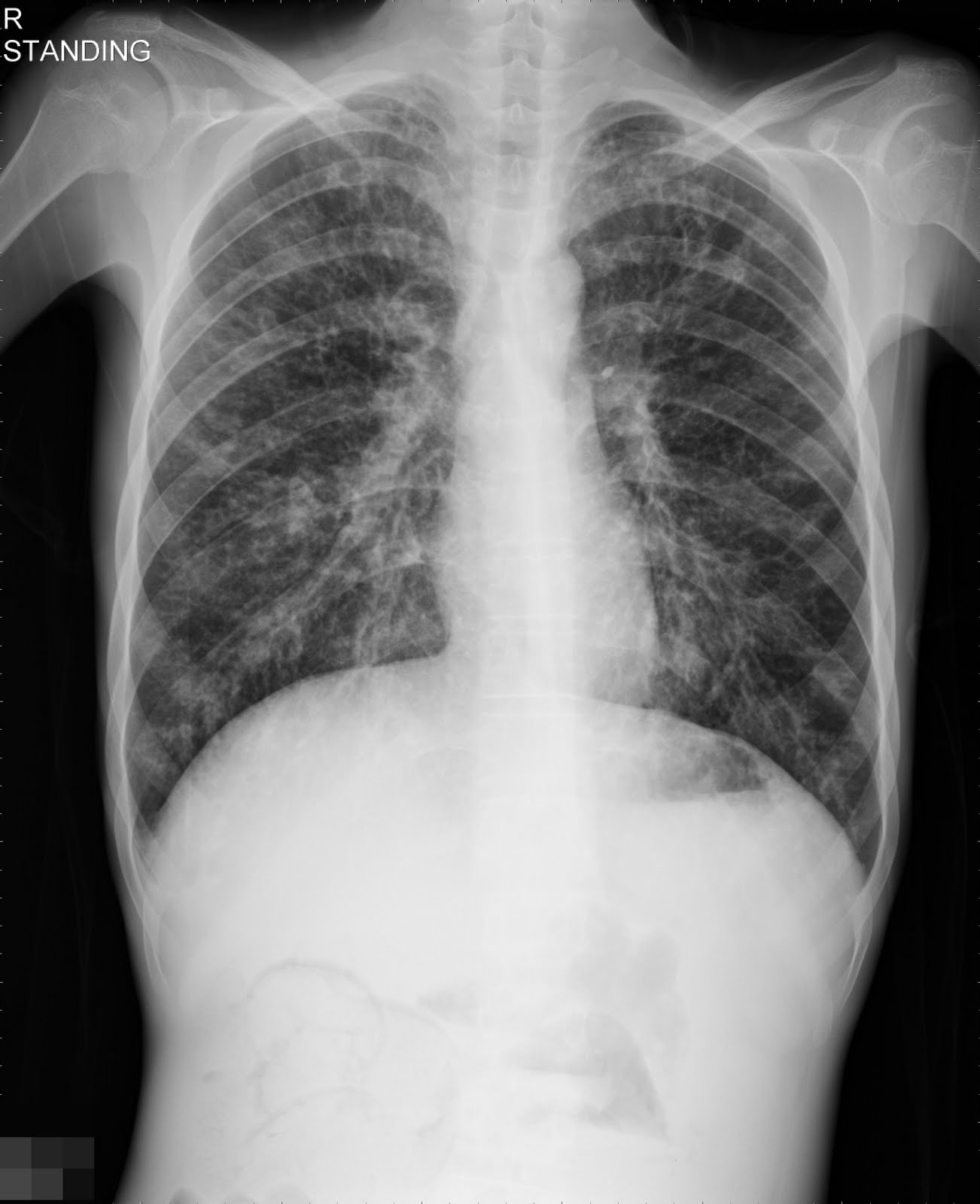 CXR 胸部x光判讀 bronchiectasis