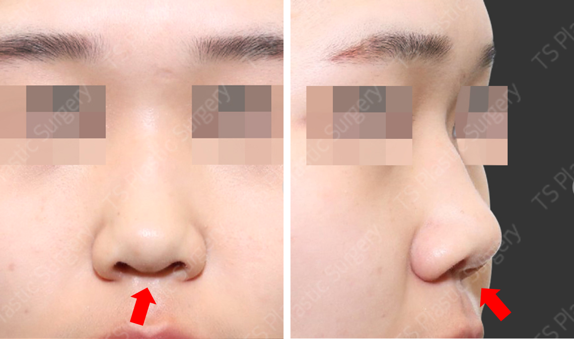 Lowering the columella(a column of the nose) in Rhinoplasty