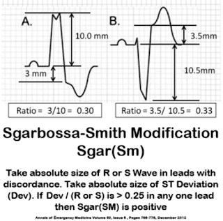 Sgarbossa Criteria Untuk Diagnosis AMI pada LBBB | INA - ECG