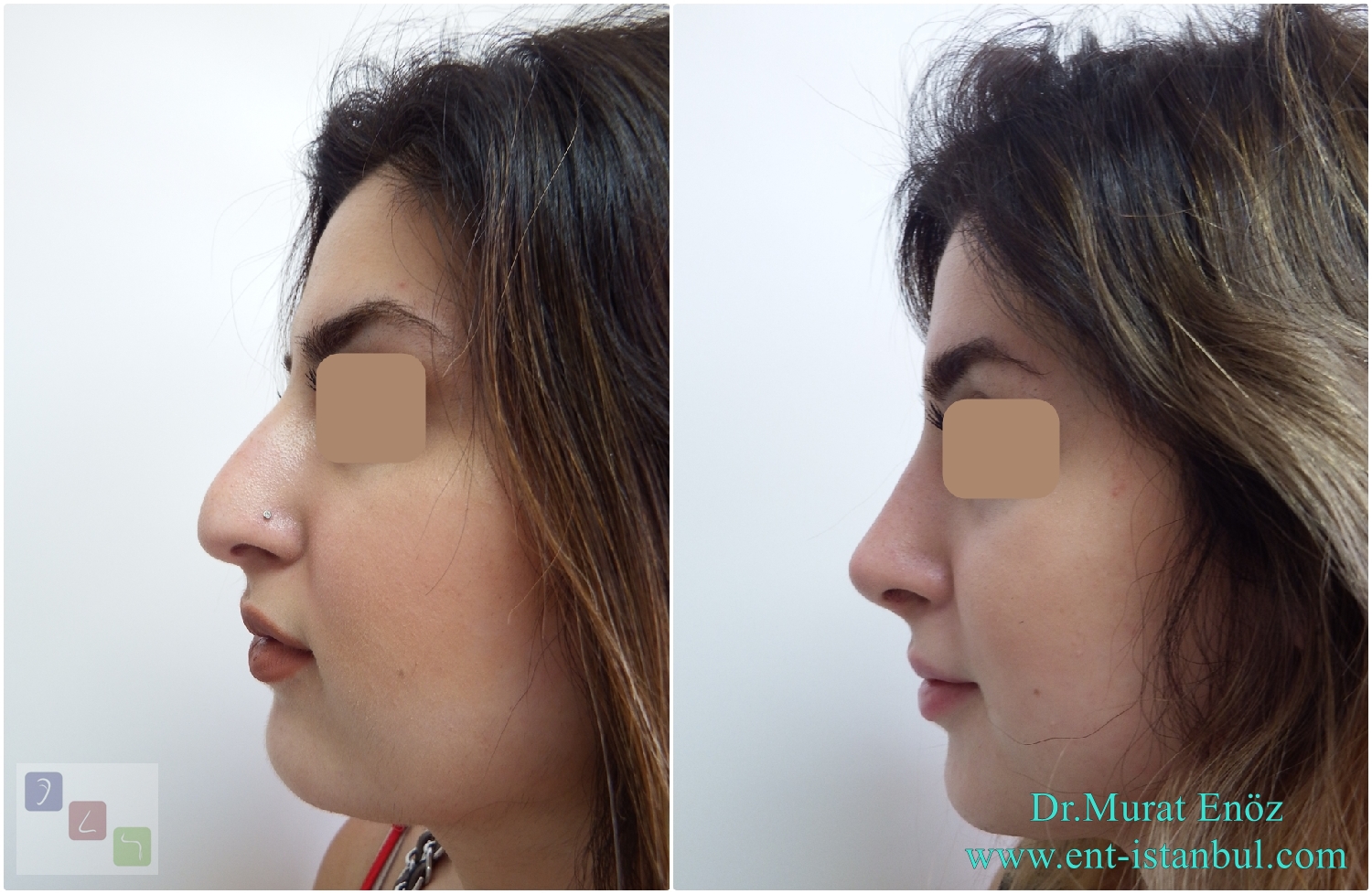 Health Zone Turkey: Nose Job in Istanbul, Turkey