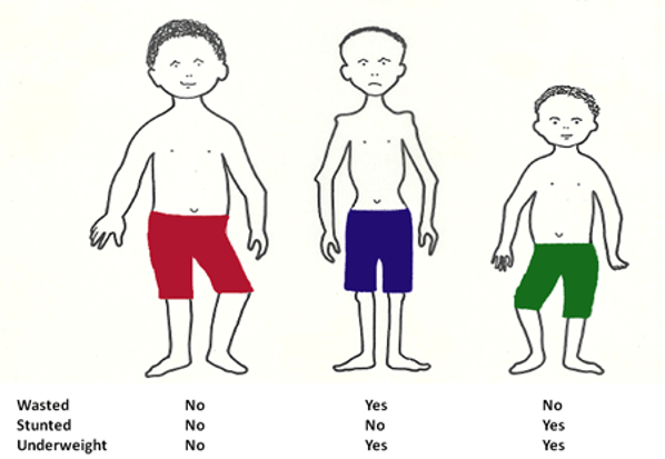 CONCEPT – STUNTING, WASTING, UNDERWEIGHT | PT's IAS Academy