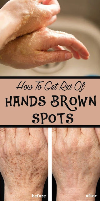 How to get rid of hand brown spots - medicine health life