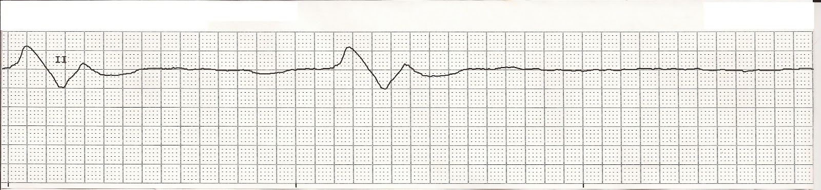 ACLS Rhythms: Ventricular rhythms