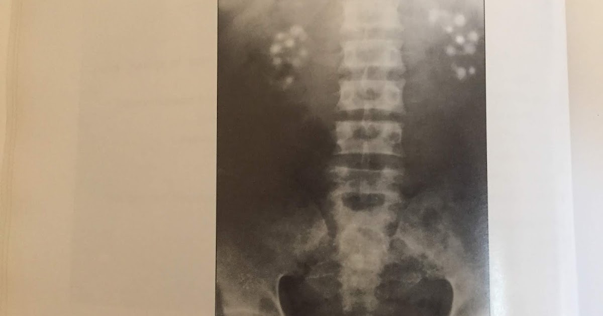 XRAYS OF NEPHROCALCINOSIS