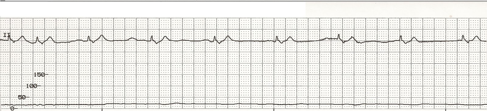 Float Nurse: Various rhythms with arterial blood pressure waveform