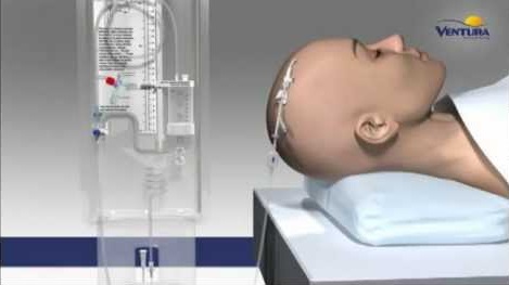 Cuidar em Enfermagem: Cuidados com o Cateter de PIC - Hipertensão ...