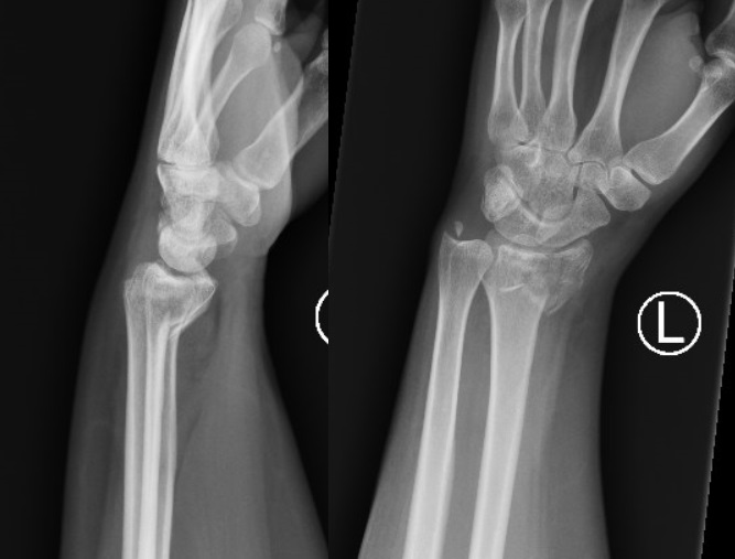 Smith Fracture Treatment | Smith Bone Fracture Surgery