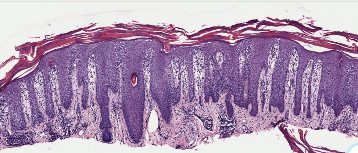 Differential Diagnosis in Dermatopathology: 2014