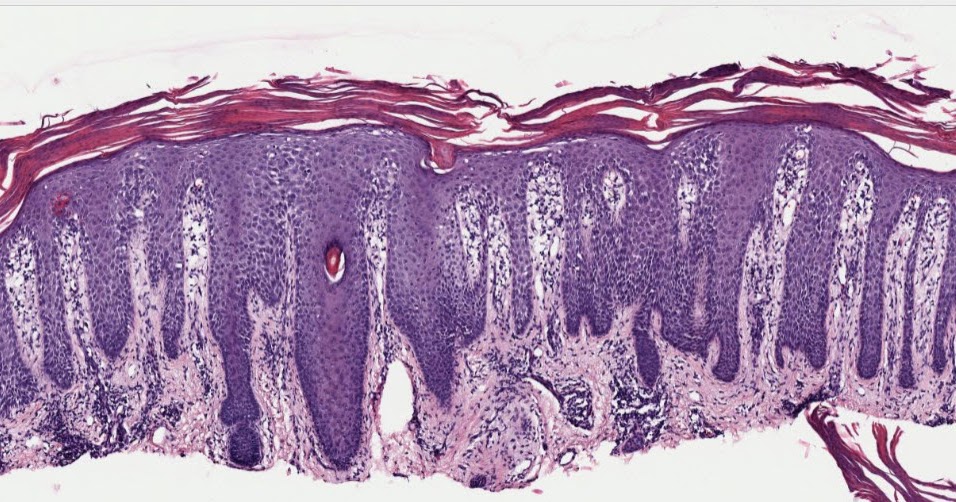 Differential Diagnosis in Dermatopathology: Parakeratosis