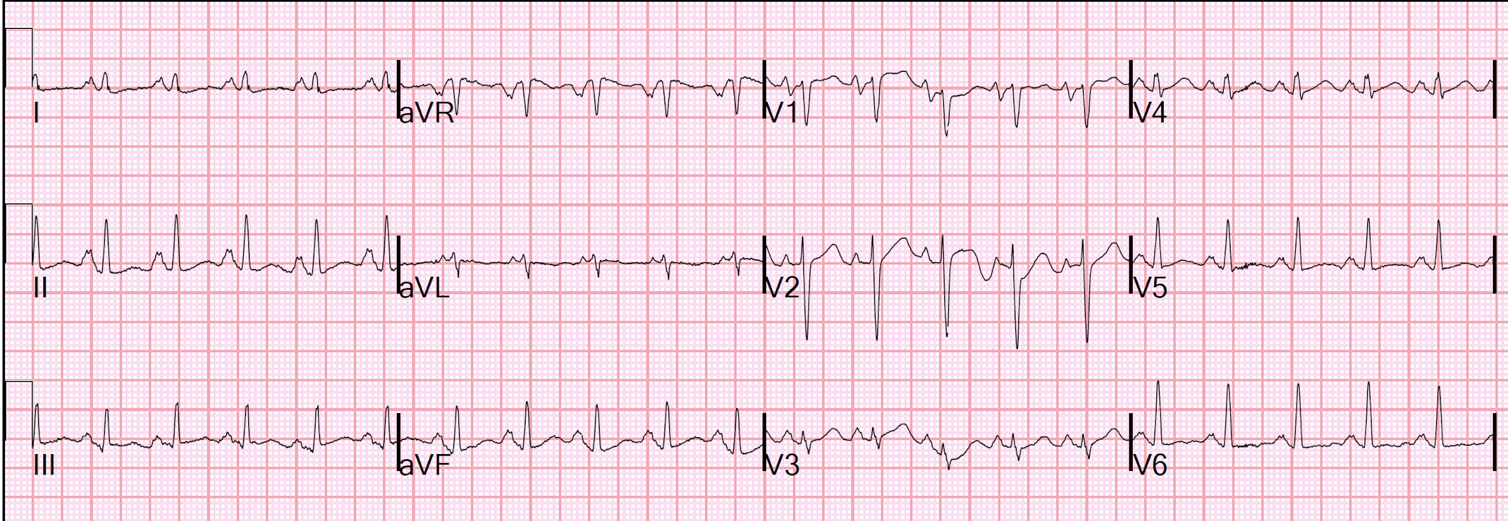 Cath Lab Stemi at Daniel Pomeroy blog