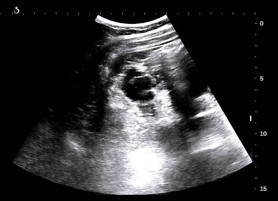 VIETNAMESE MEDIC ULTRASOUND: CASE 579: ACUTE APPENDICITIS in PREGNANCY ...