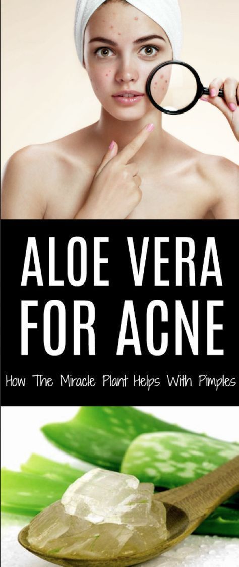Best DIY Aloe Vera recipes for Acne