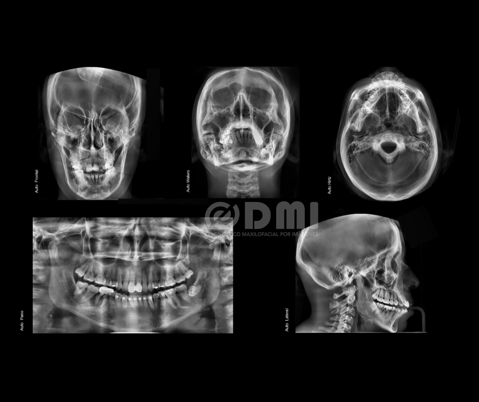 Diagnóstico Maxilofacial por Imágenes: noviembre 2019