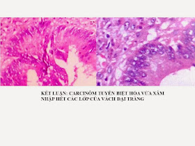 VIETNAMESE MEDIC ULTRASOUND: CASE 239: COLON TUMOR and WALLED-OFF ...