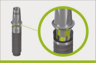 NHA KHOA THẨM MỸ NÉT VIỆT : Straumann Implant CrossFit