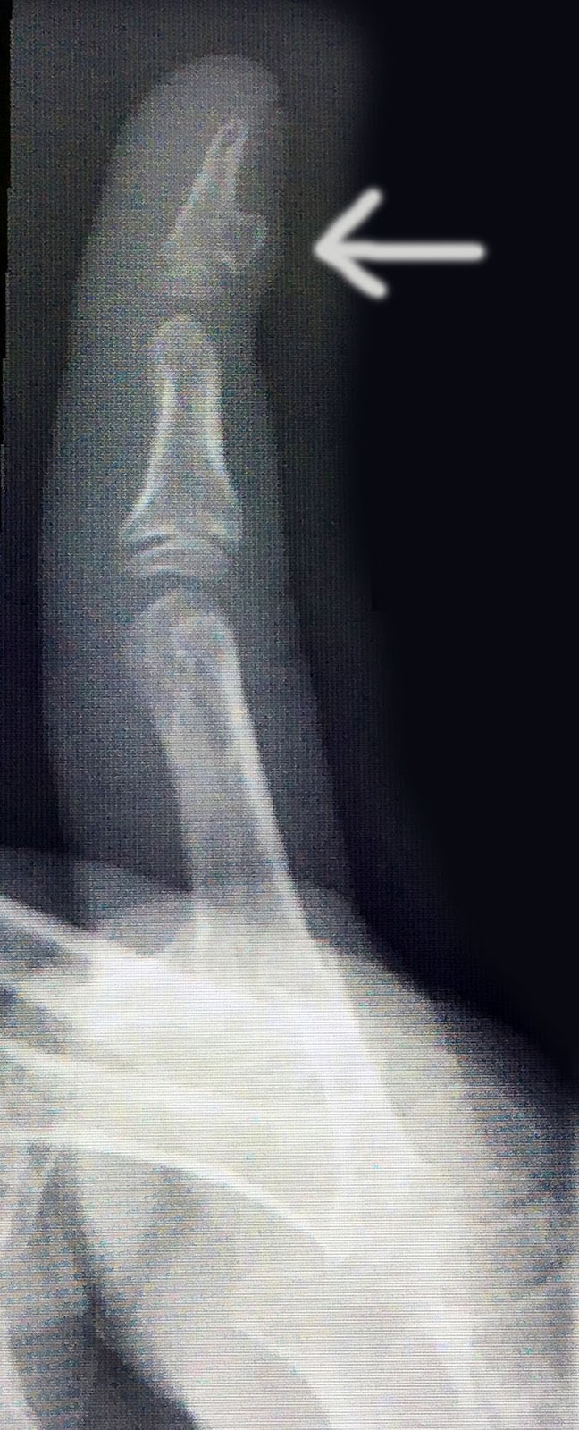 Fingernail Bump | Congenital Hand and Arm Differences | Washington ...