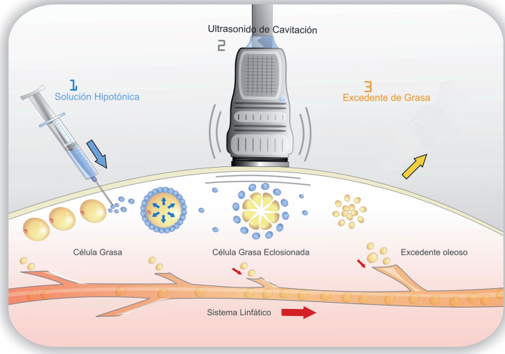 AB Esthetic: Aesthetic Medicine for Dummies - Liposculpture Without Surgery