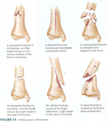 Anatomy & Physiology: Bone Fractures