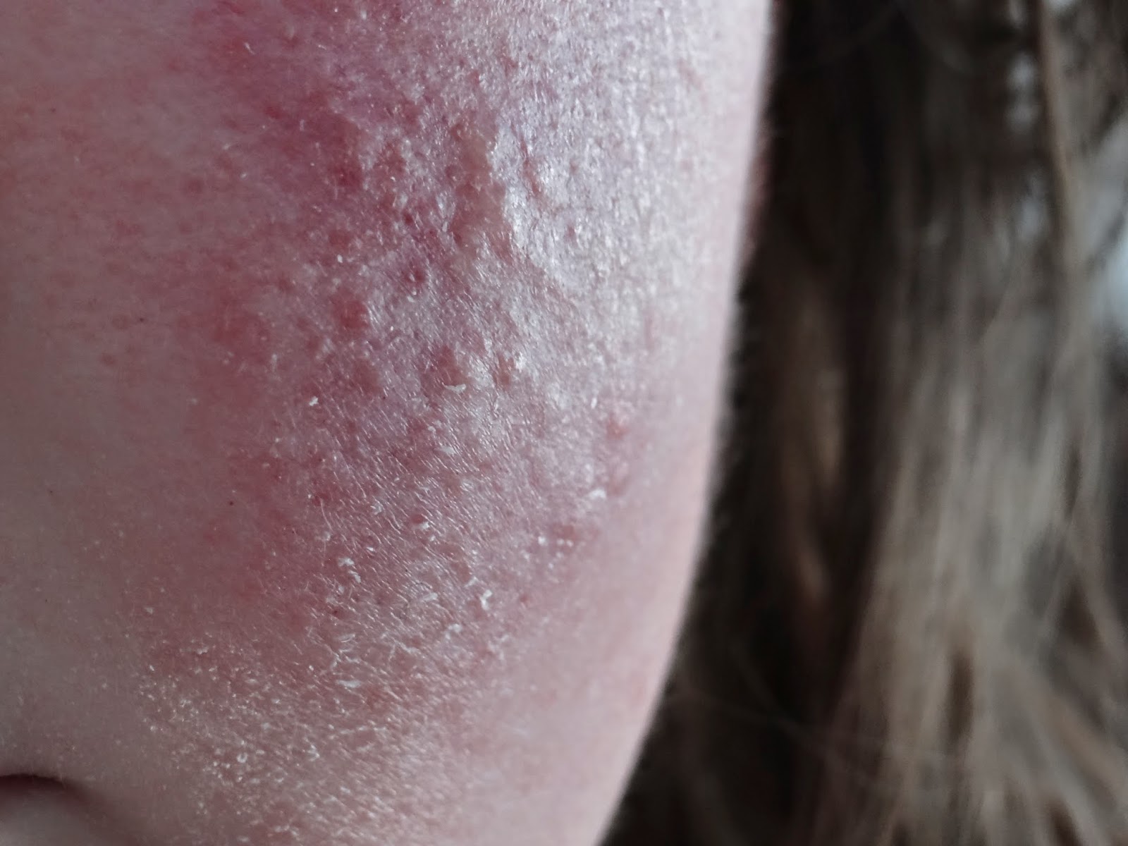 Scarlet Letters, dealing with vascular rosacea, face flushing, burning ...