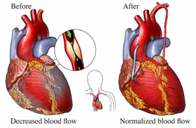 Risks & Benefits of Coronary Artery Bypass Graft (CABG) Surgery ...