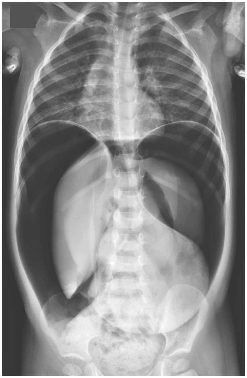 Neumoperitoneo por perforación gástrica | Levántate y piensa