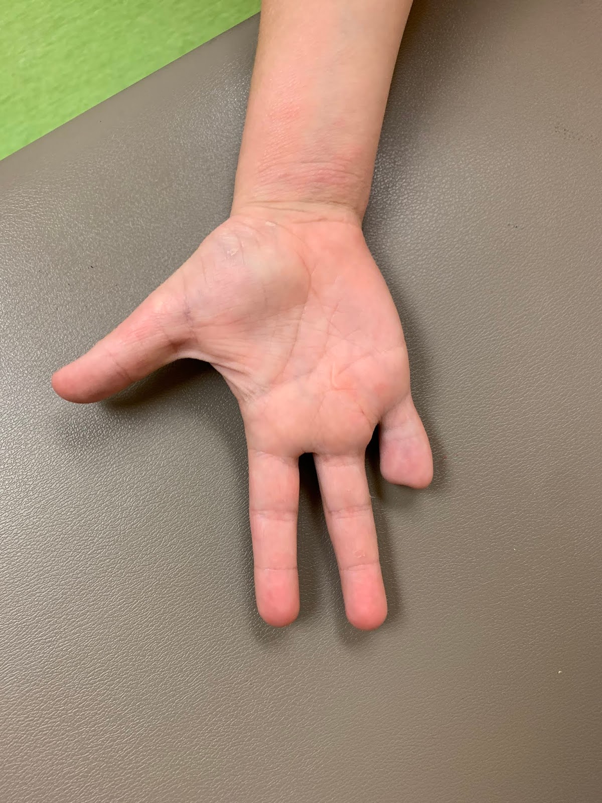 Ulnar cleft hand, part II | Congenital Hand and Arm Differences ...
