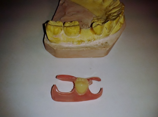 Prótesis dentales: Prótesis flexibles TCS Iflex o Partial Flex