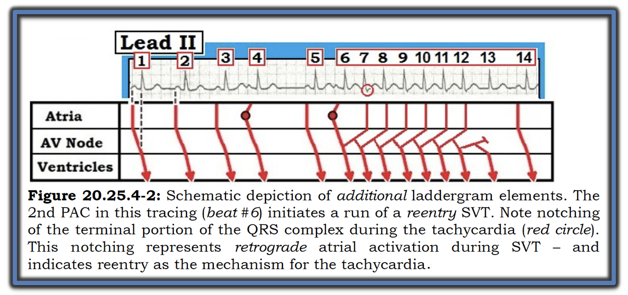 ECG Interpretation: ECG Blog #188 - How to Read/Draw Laddergrams