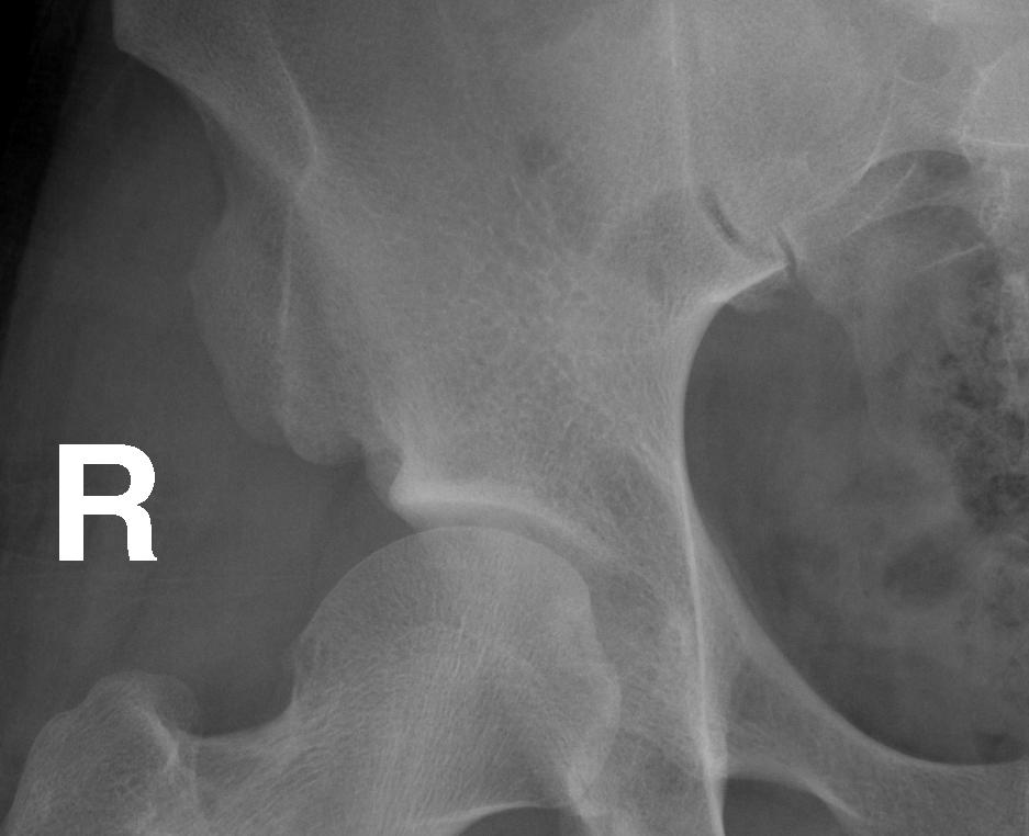 Roentgen Ray Reader: Post-Traumatic Exostosis