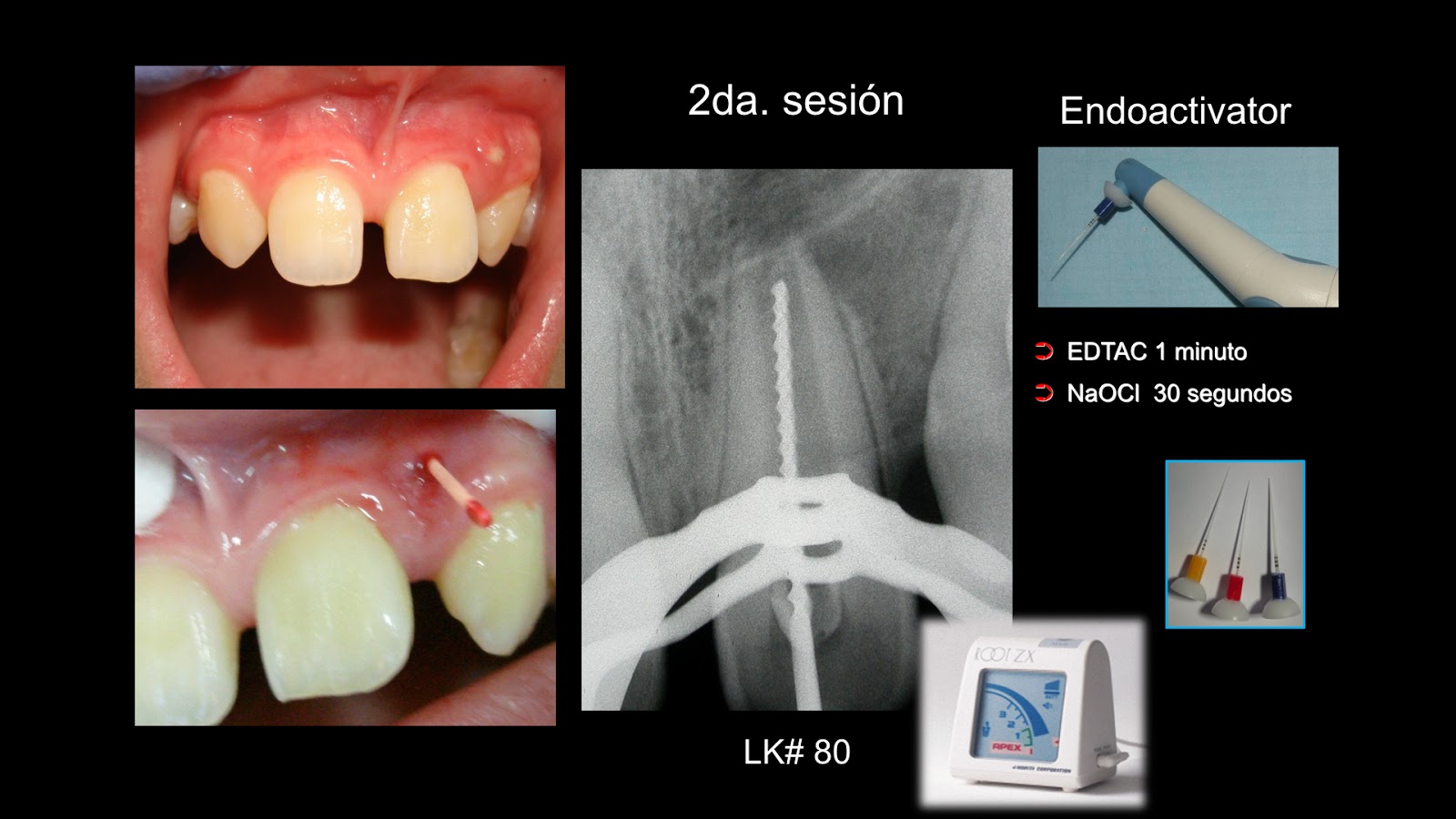SECCION PARA ALUMNOS ENDODONCIA II