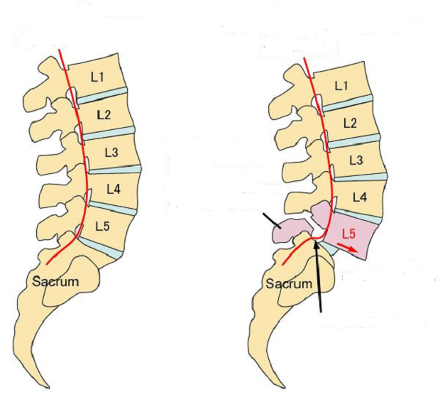 Schiena OK: SPONDILOLISI E SPONDILOLISTESI