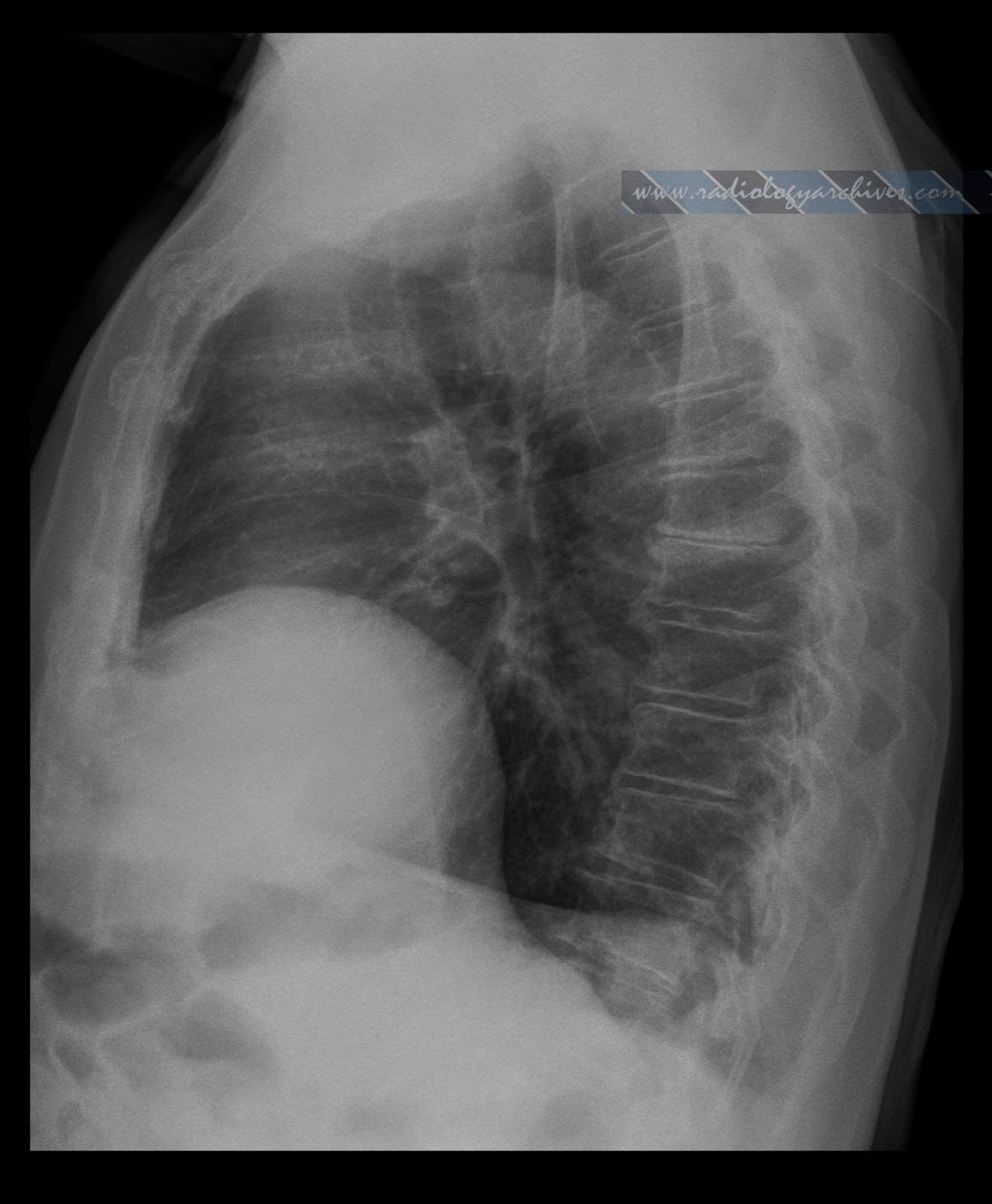 Radiology Archives: Ύβωση Ημιδιαφράγματος (Eventration of Diaphragm)