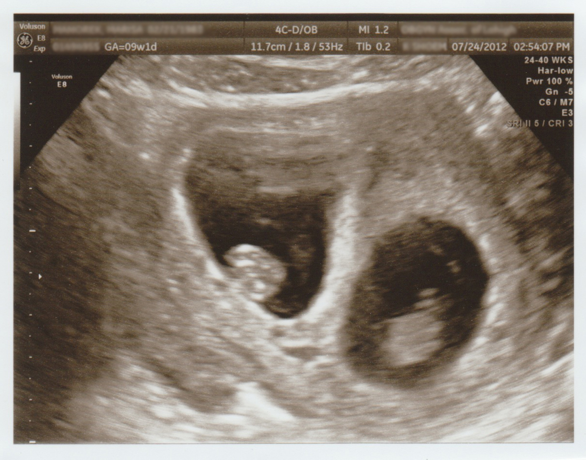 Wishing for Our Little Star: 9 Weeks 1 Day