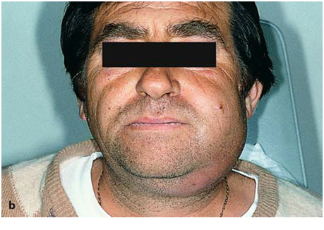 Odontogenic Infections-Oral Surgery Lecture Note ~ Dentistry and Medicine