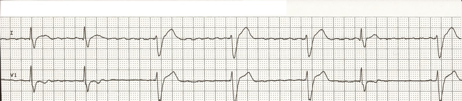 EKG Rhythm Strips 23: Paced Rhythms